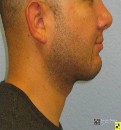 Endotine ® Ribbon Lift | Cosmetic Surgery & Laser Center of El Paso